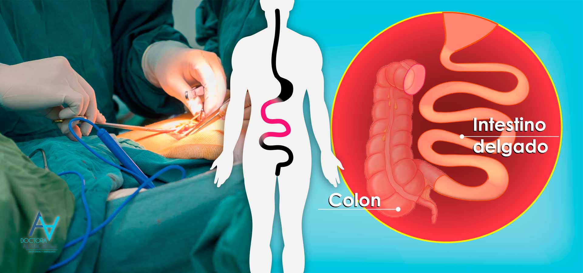 Intestino Delgado - Cirugia Digestiva